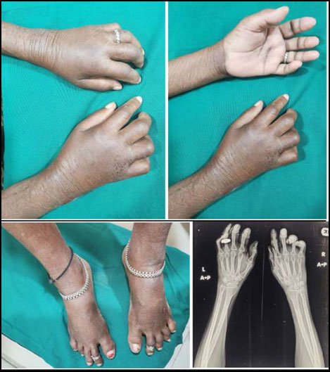 Can you identify the disease? | Indian Rheumatology Association